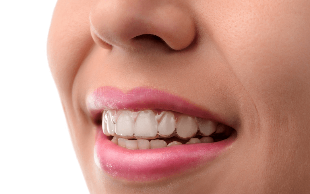 5 Steps To A Straight Smile With Invisalign Academy Dental