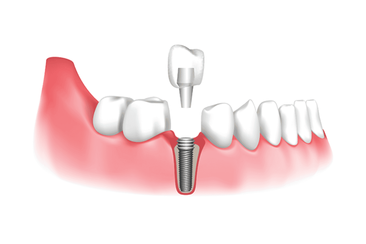 Top 8 Benefits of Dental Implants for a Better Life