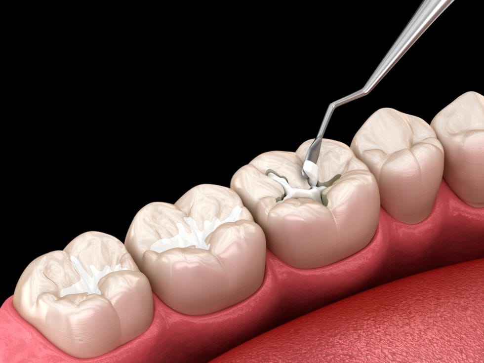 Tooth Structure You Need To Be Eligible for a Dental Crown